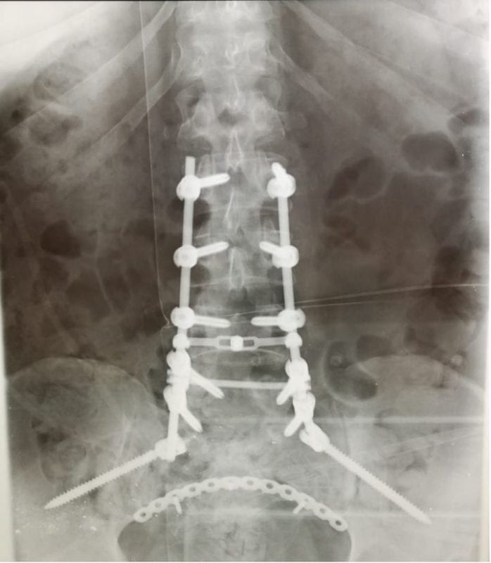 Οσφυϊκή Σπονδυλοδεσία - Νευροχειρουργός Αθήνα - Καλαμάτα | Δρ. Ανδρουλής